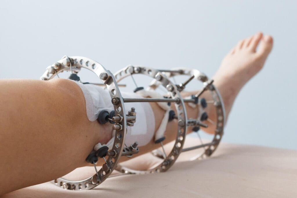 Ilizarov techniques | Orthopedic Surgeon | Dr. Ahmed Thabet Hagag MD